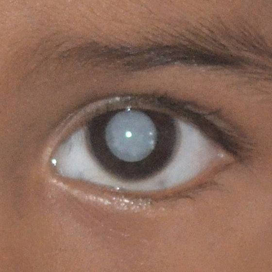 Adult Cataract